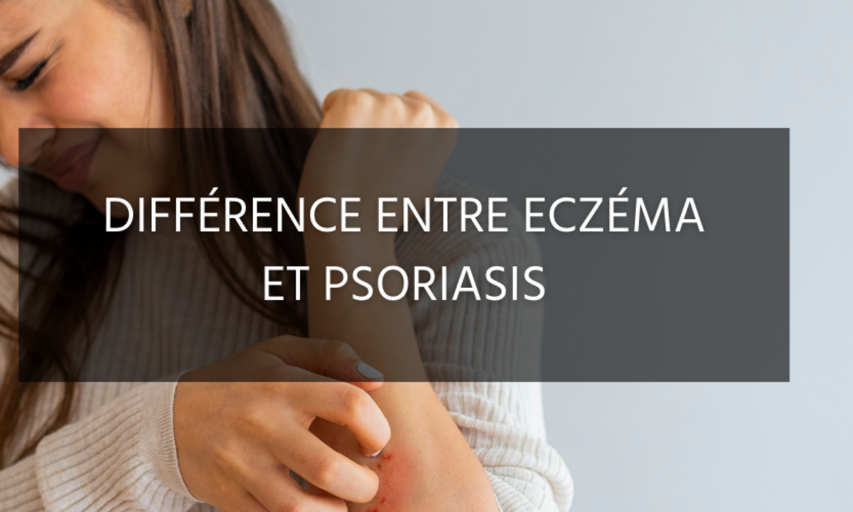Eczéma Dyshidrotique Du Visage