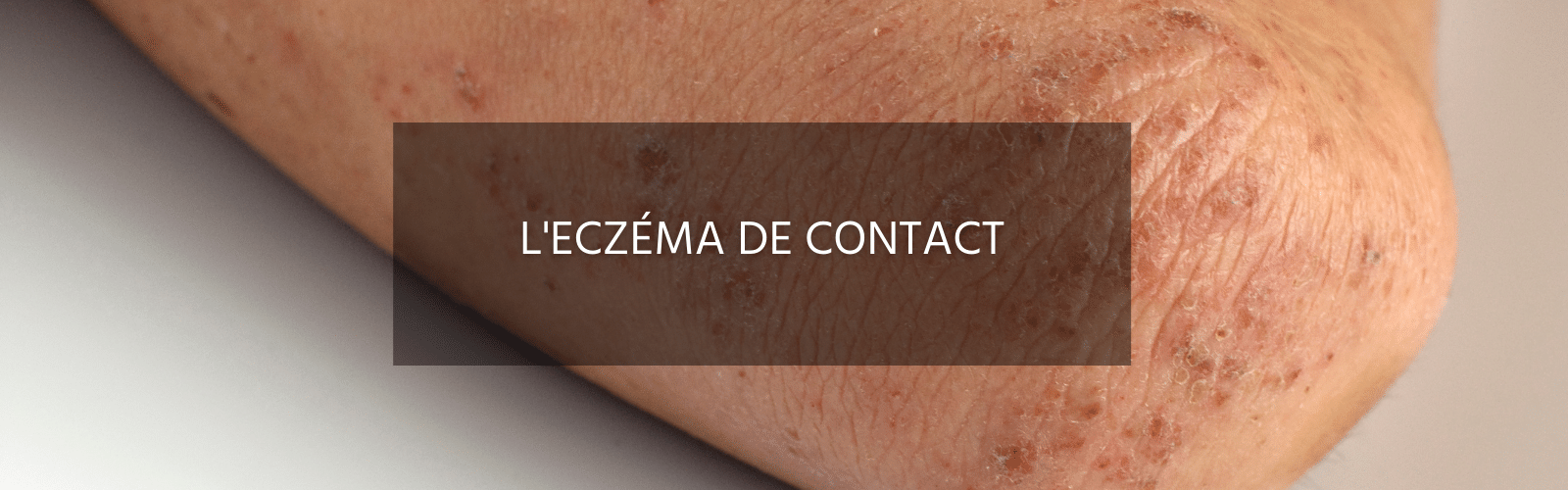Comprendre l'eczéma de contact irritatif