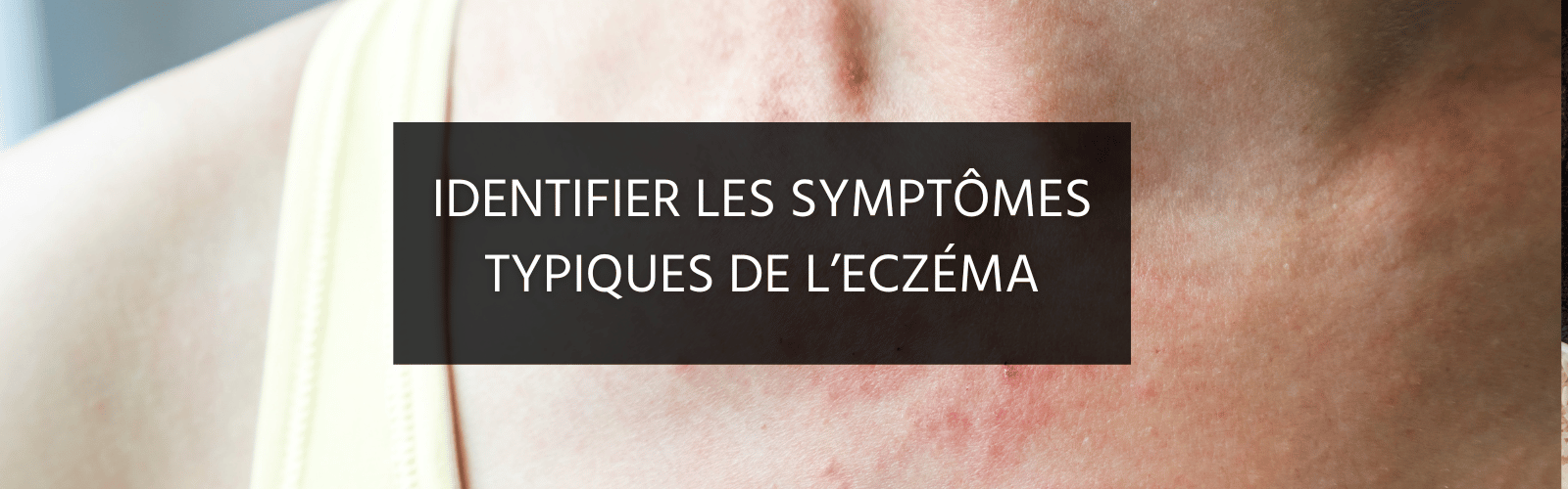 Identifier les symptomes de l'eczéma