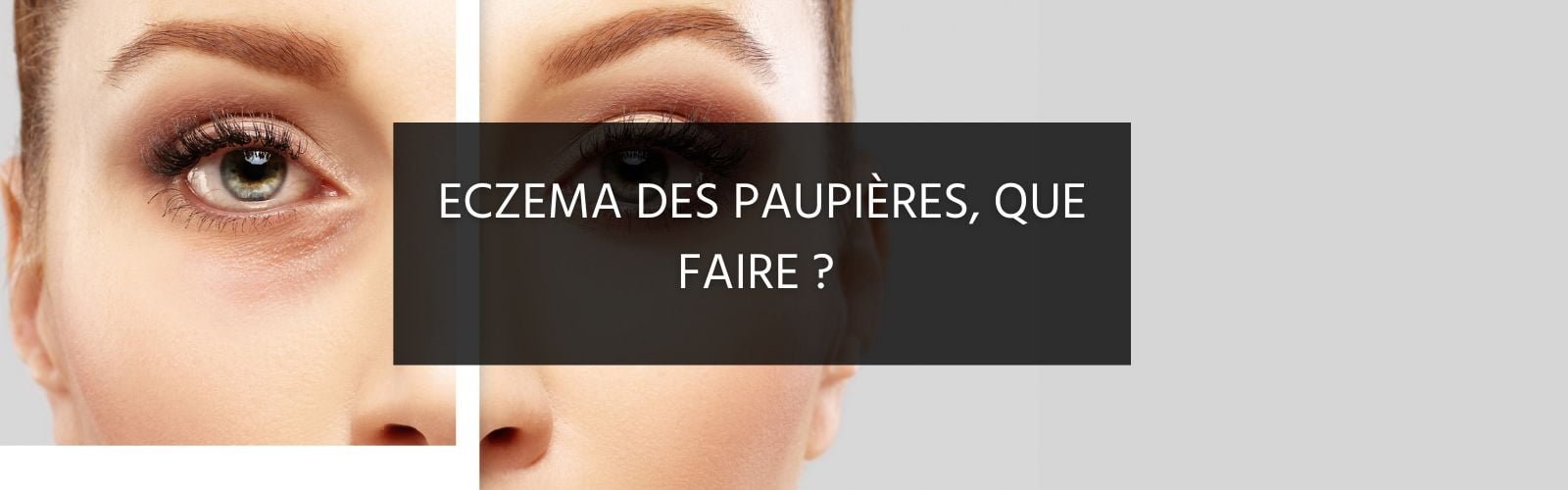 Eczéma sur les paupières : mes 5 astuces