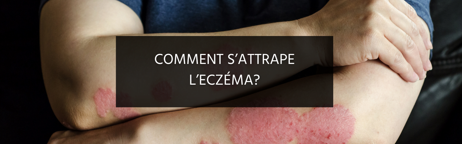 Comment s’attrape l’eczéma