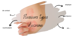 Traitements pour l'eczéma : la liste complète