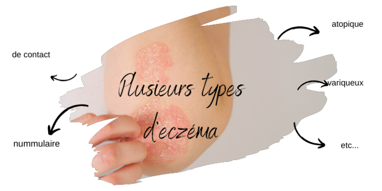 Traitements pour l'eczéma : la liste complète