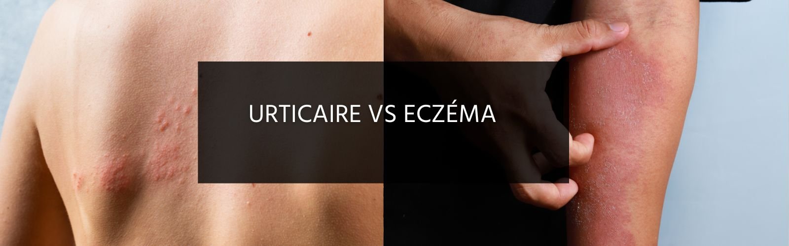 La différence entre l’urticaire et l’eczéma