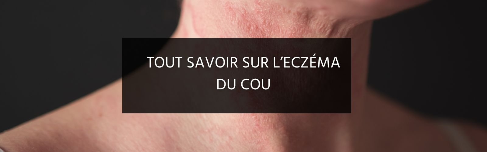Eczéma au cou : signification, remèdes, & explications