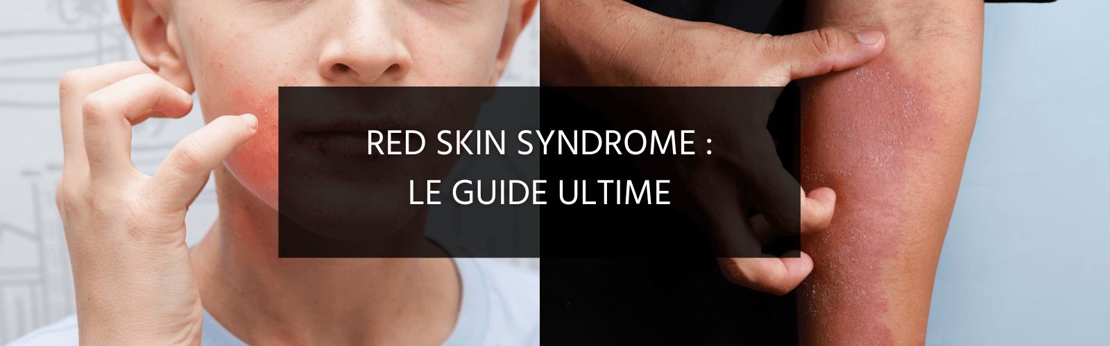 Red Skin Syndrome, l'effet rebond après l'arrêt de la cortisone